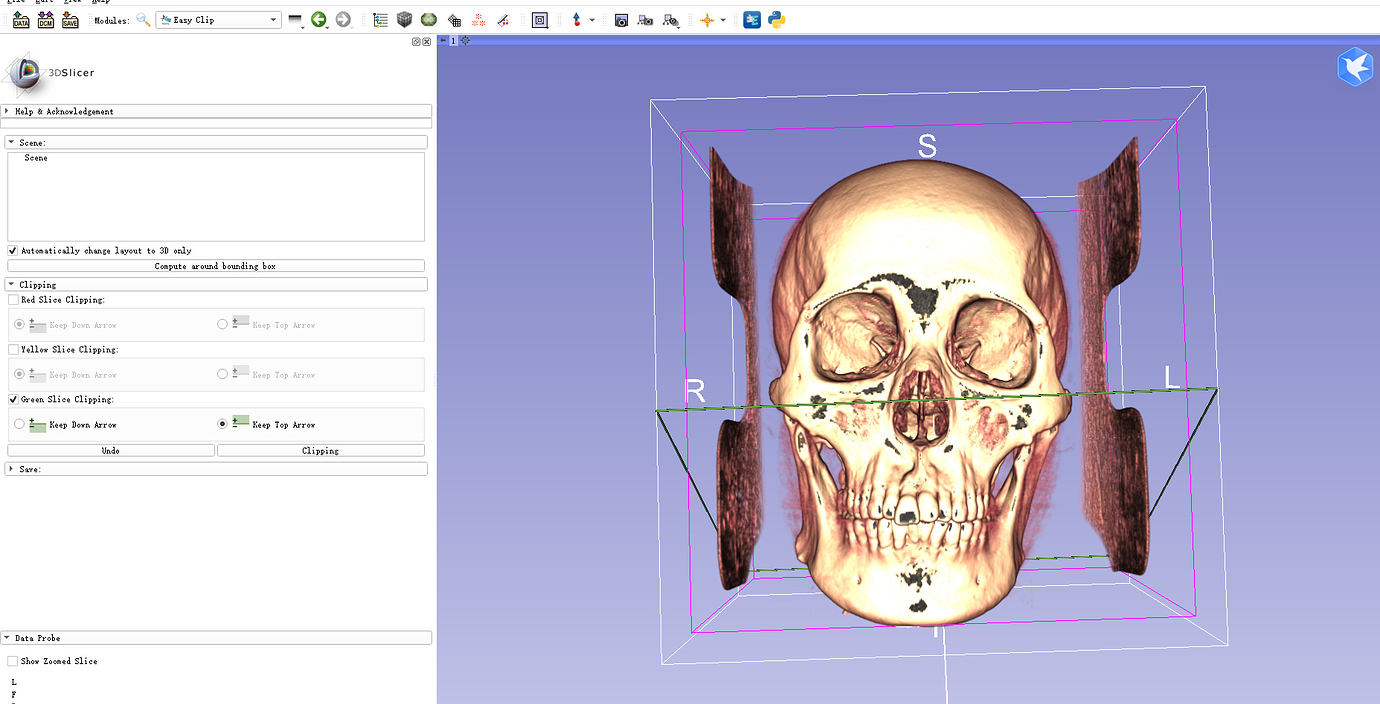 easy clip模块无法使用 - 问题求助 - 3DSlicer中文论坛