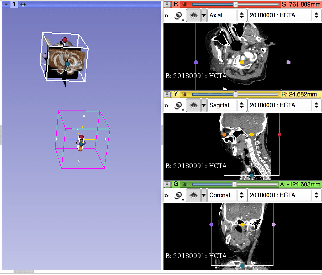 天天练011-体绘制（3D渲染）ROI参数设置 - 天天练 - 3DSlicer中文论坛