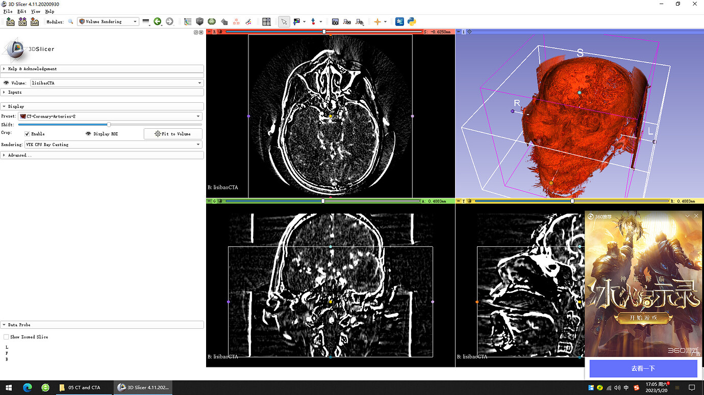 CTA血管减影详细教程附练习数据 - 经验分享 - 3DSlicer中文论坛