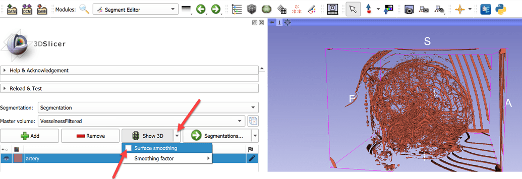 CTA血管减影详细教程附练习数据 - 经验分享 - 3DSlicer中文论坛