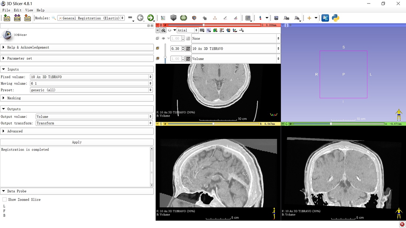 利用3D Slicer对CT和MRI图像一键配准融合 - 经验分享 - 3DSlicer中文论坛