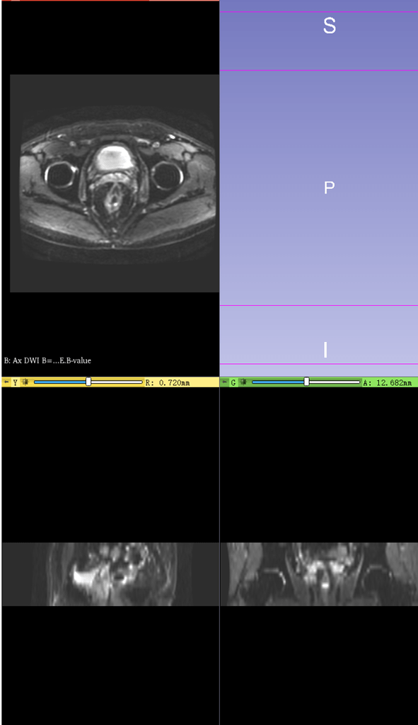 DWI图像，只显示b=0的，b=1000的图像不显示 - 问题求助 - 3DSlicer中文论坛