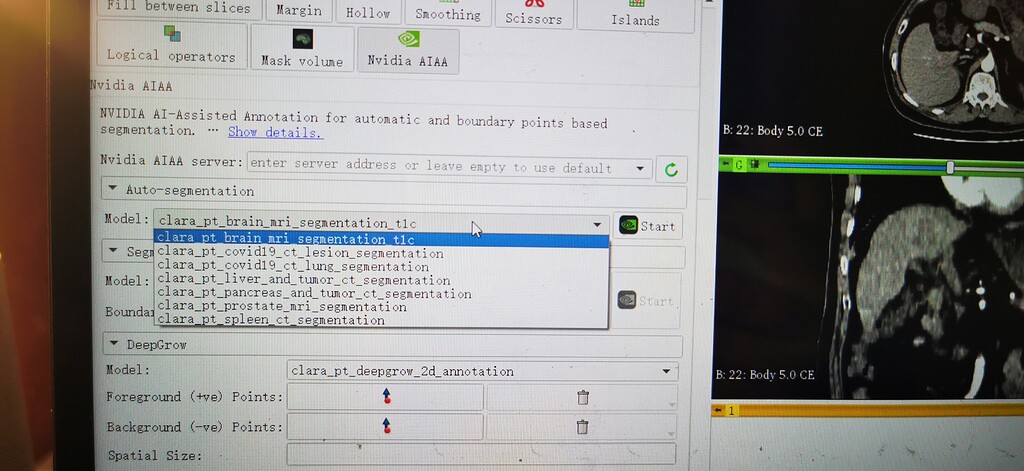 Nvidia AIAA 无法自动分割肝脏 - 问题求助 - 3DSlicer中文论坛