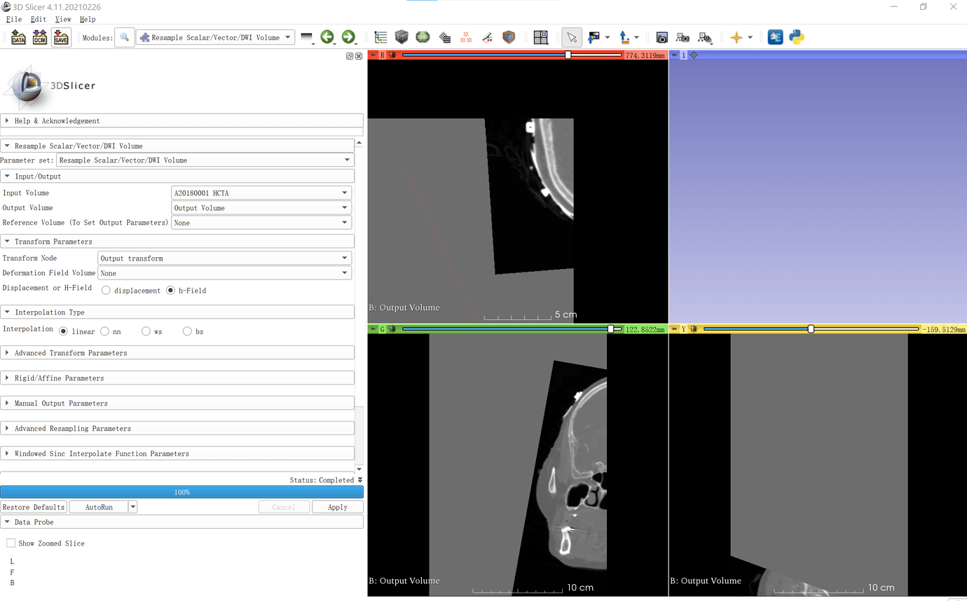 018-调正中线2 - 分割与建模 - 3DSlicer中文论坛