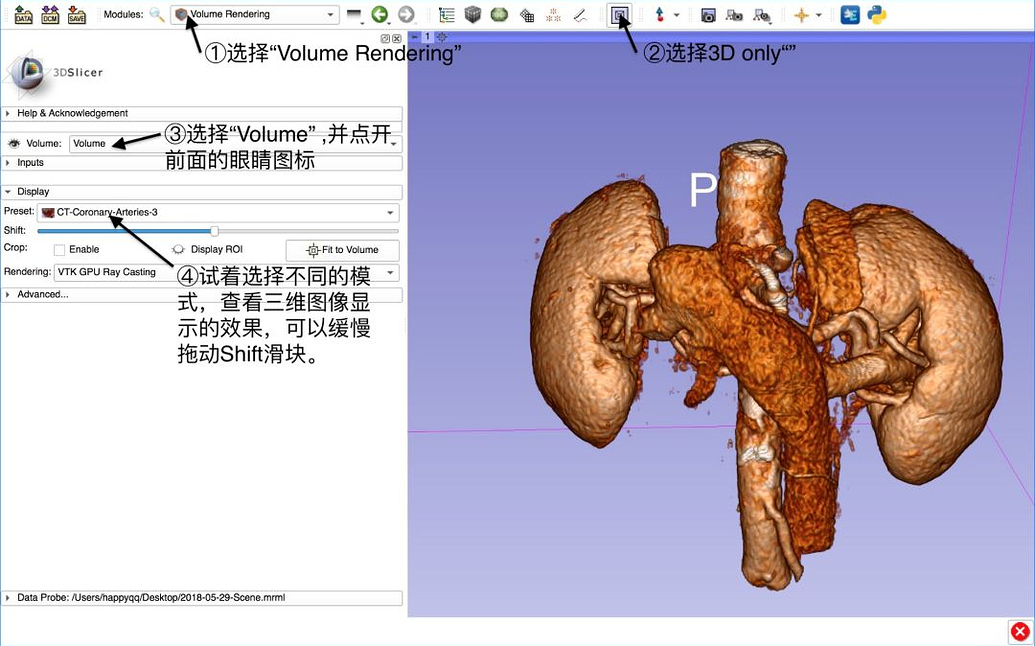 3D Slicer在肾肿瘤中的应用 - 经验分享 - 3DSlicer中文论坛